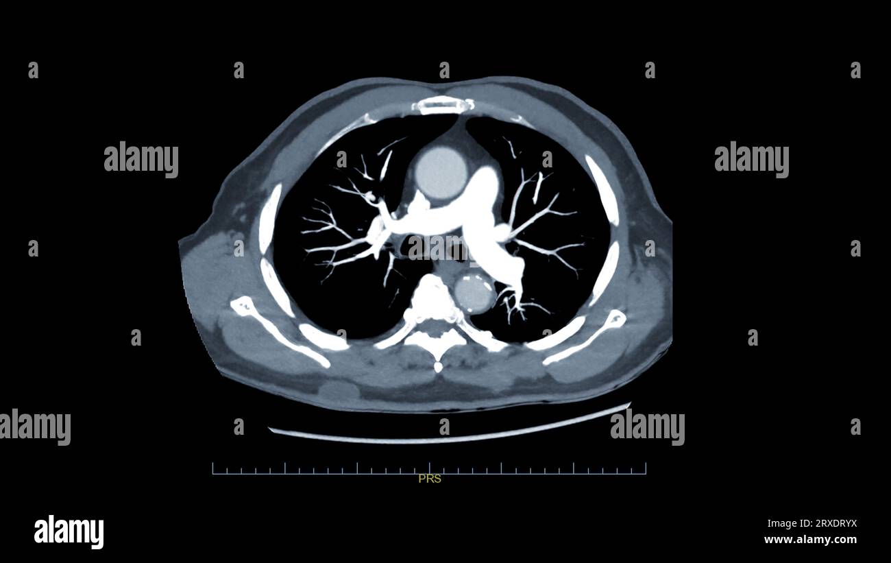 CTPA or CTA pulmonary artery for diagnostic Pulmonary embolism (PE ...