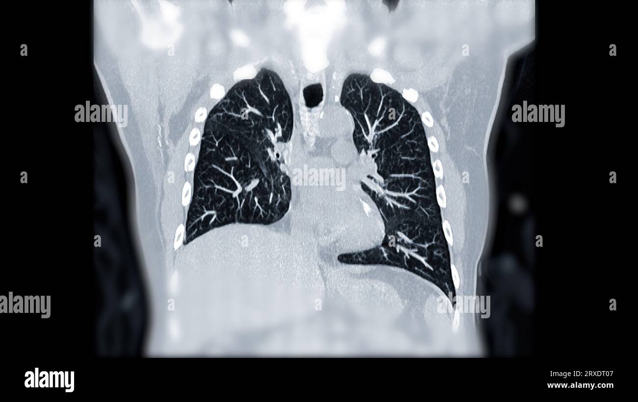CTPA or CTA pulmonary artery for diagnostic Pulmonary embolism (PE ...