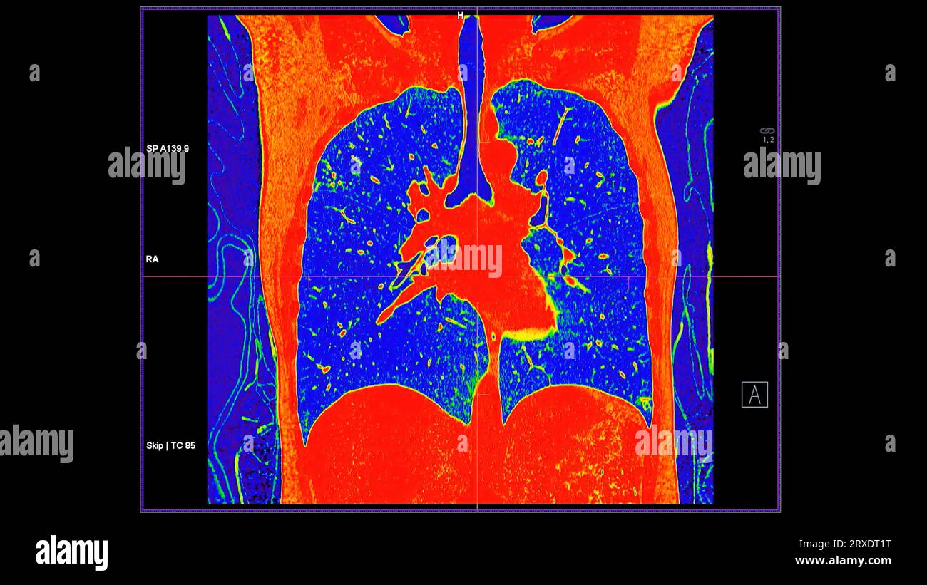 CT scan of Chest coronal view in color mode for diagnostic Pulmonary ...