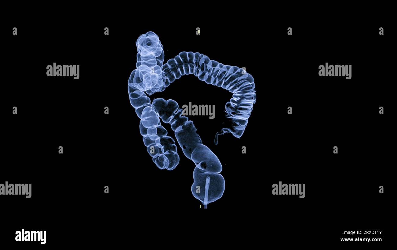 CT colonography 3D rendering image for annual health check-ups to ...
