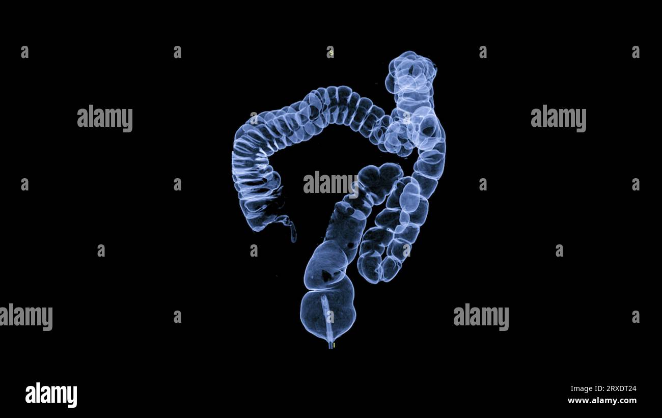 CT colonography 3D rendering image for annual health check-ups to ...