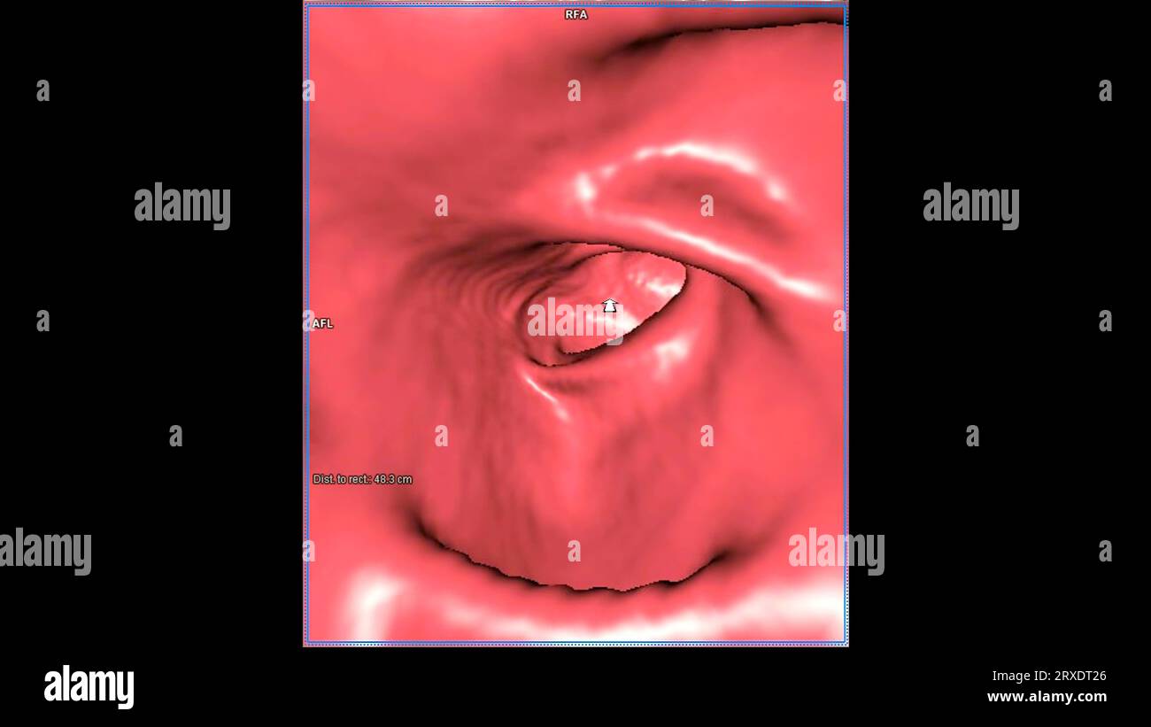Ct Colonography 3d Rendering Image For Annual Health Check Ups To