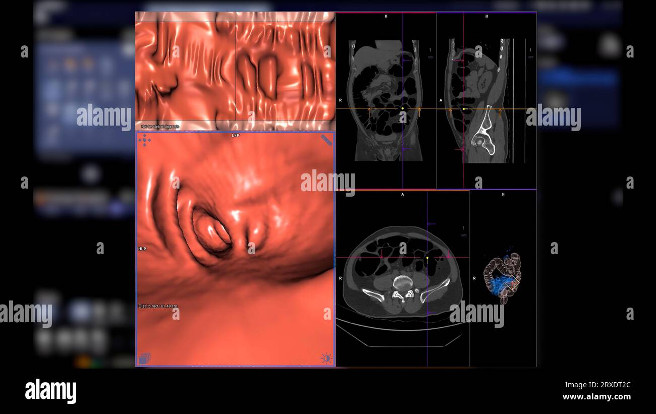 CT colonography compare 2D Axial,sagittal ,coronal plane and 3D ...