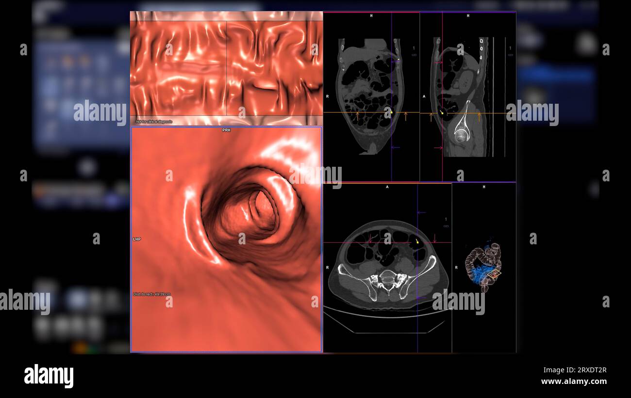 CT colonography compare 2D Axial,sagittal ,coronal plane and 3D ...