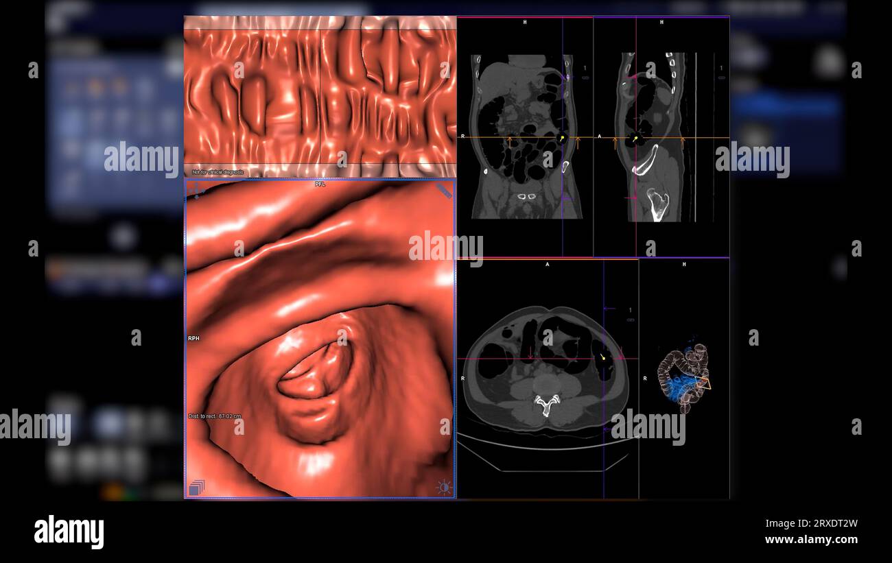 CT colonography compare 2D Axial,sagittal ,coronal plane and 3D rendering image for screening ...