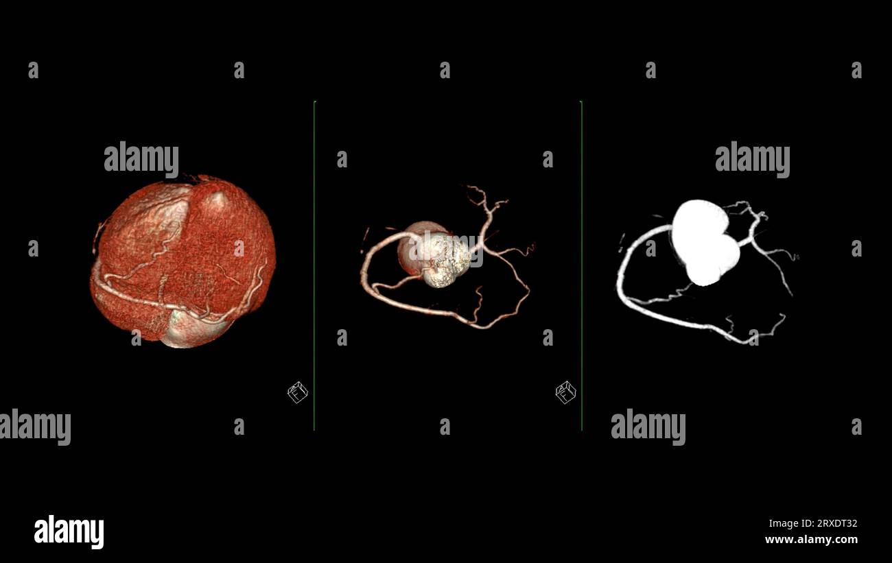 CT Cardiac 3D rendering or CTA coronary artery for prevention coronary ...
