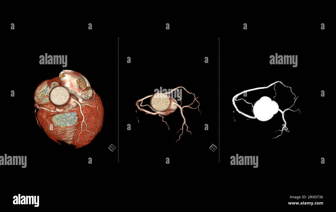 CT Cardiac 3D rendering or CTA coronary artery for prevention coronary ...