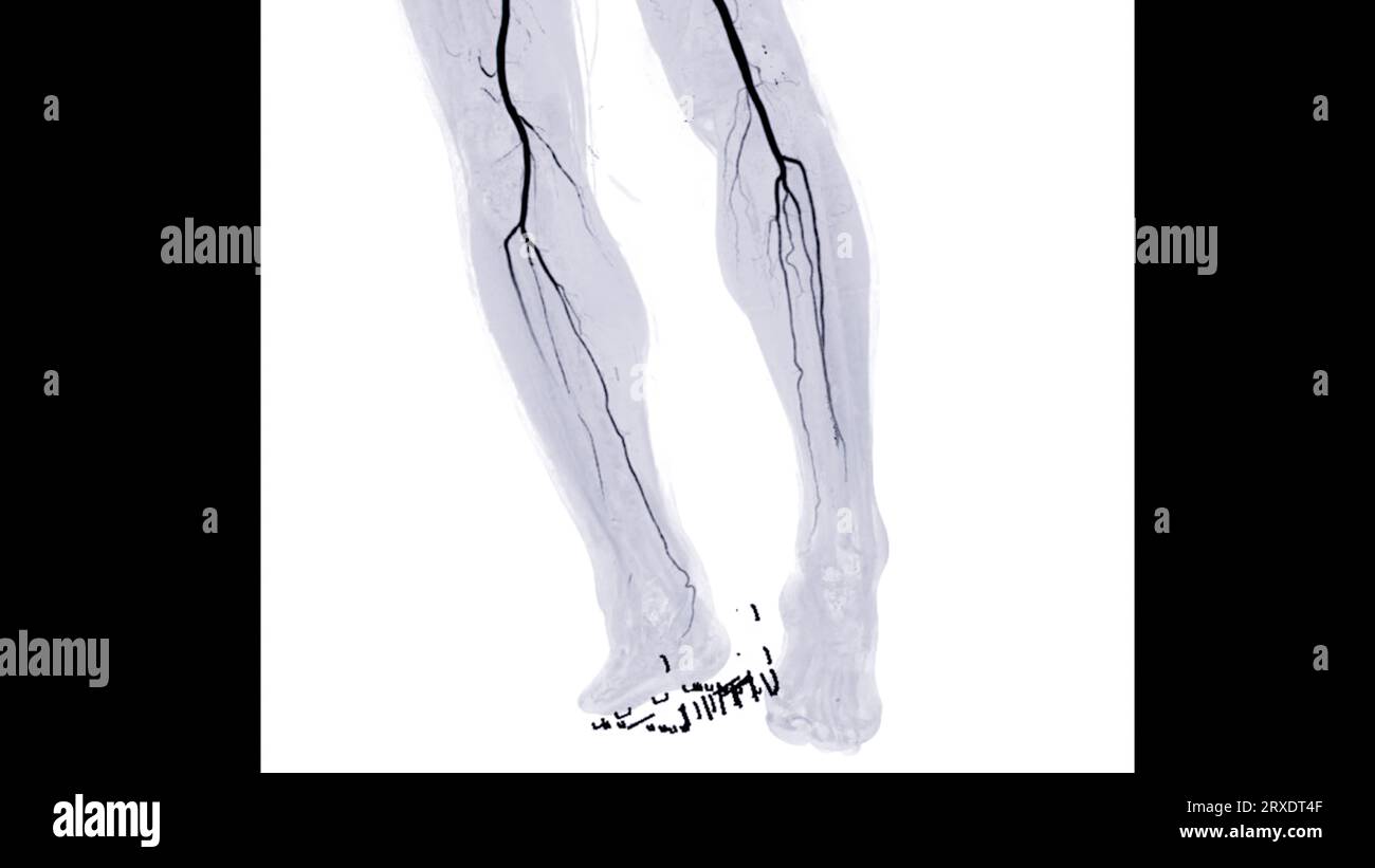 CTA femoral artery run off showing femoral artery for diagnostic Acute ...