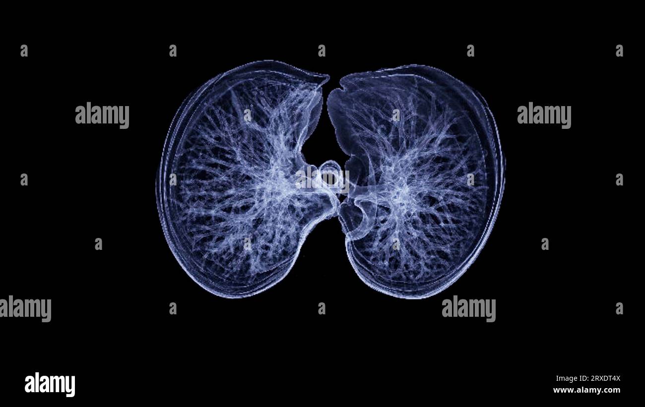 CT Chest or CT lung 3d rendering image with blue color showing Trachea ...
