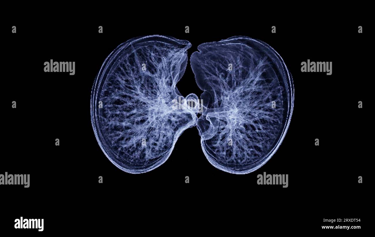 CT Chest or CT lung 3d rendering image with blue color showing Trachea ...