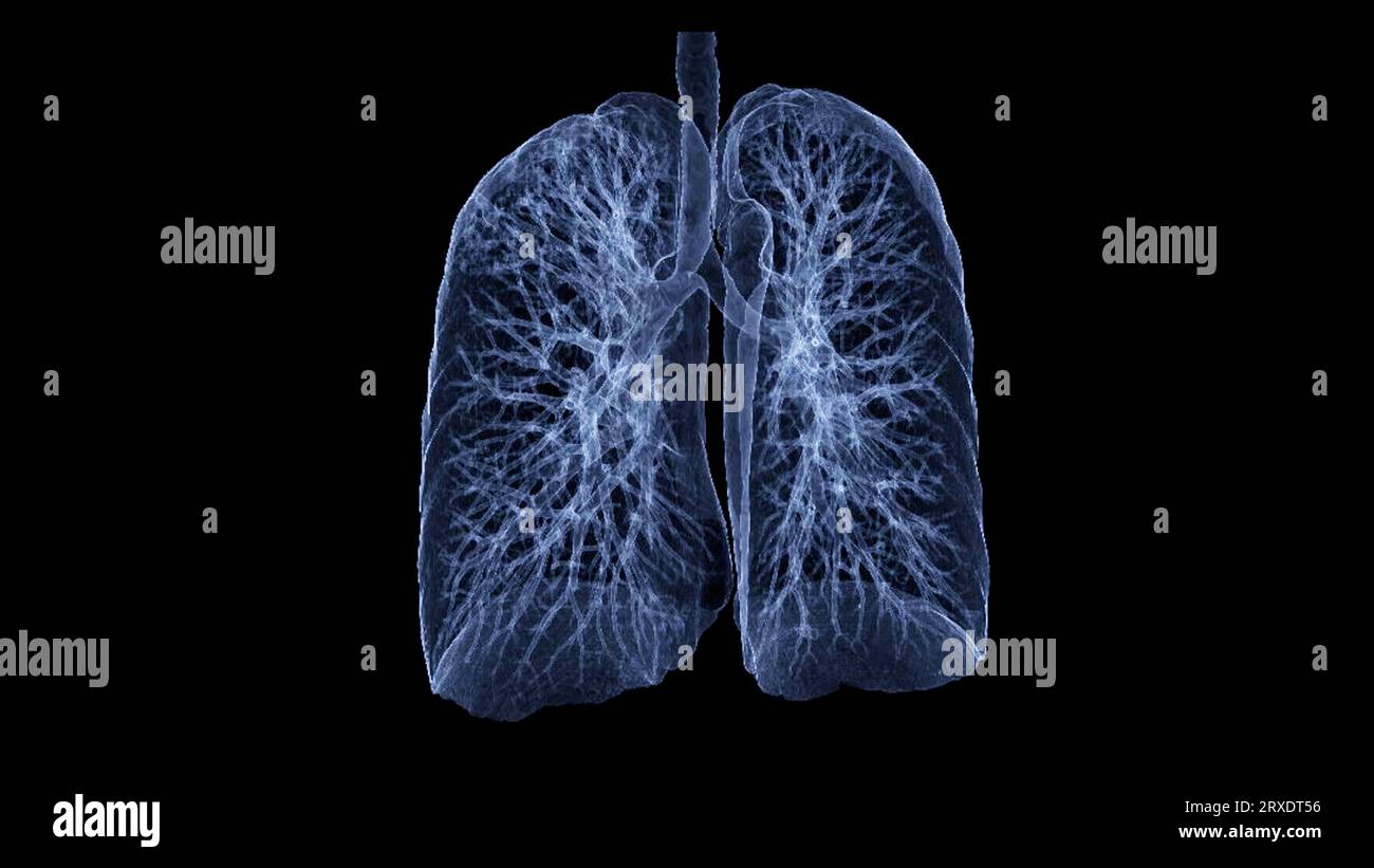 CT Chest or CT lung 3d rendering image with blue color showing Trachea ...