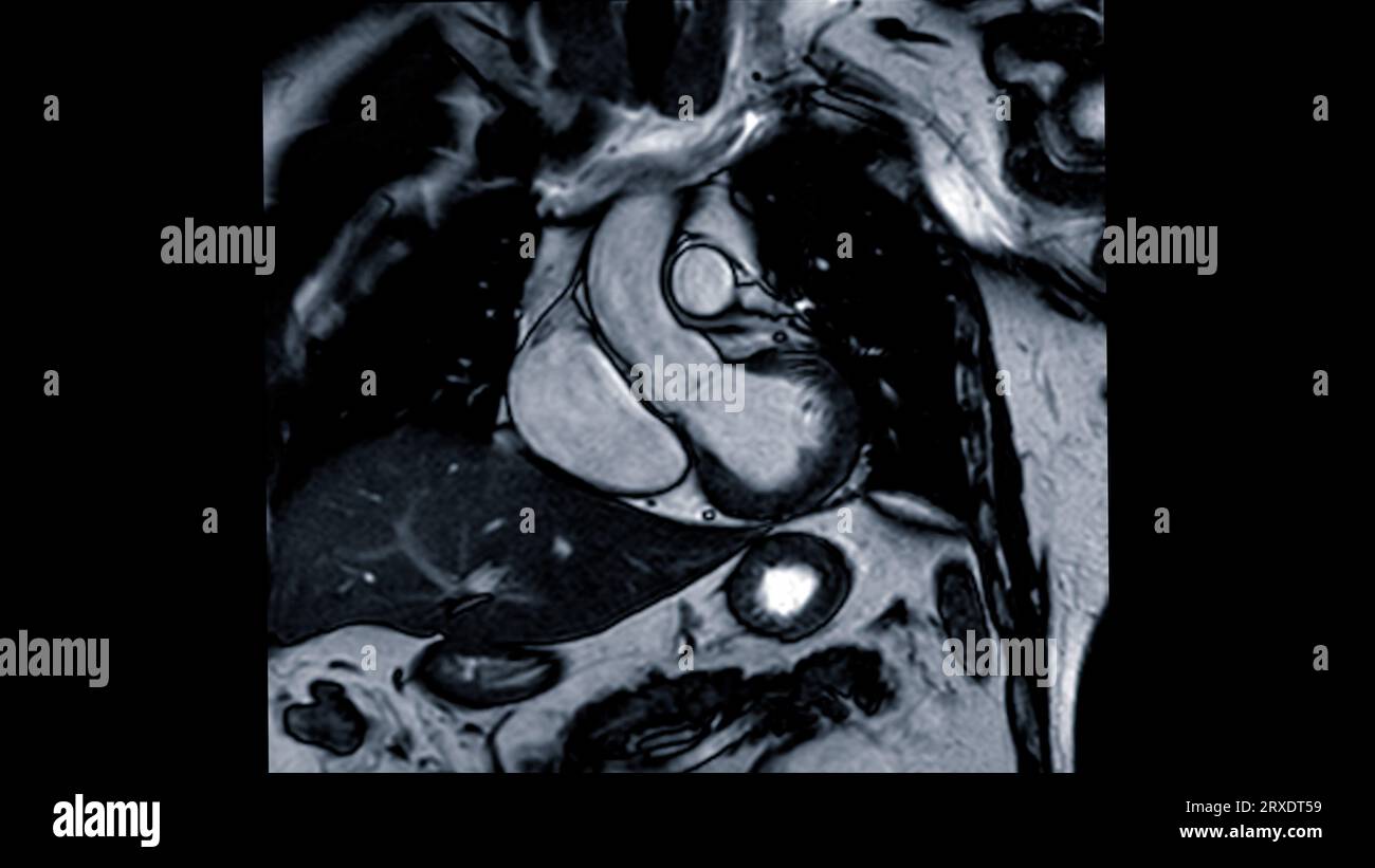 MRI heart or Cardiac MRI ( magnetic resonance imaging ) of heart in ...