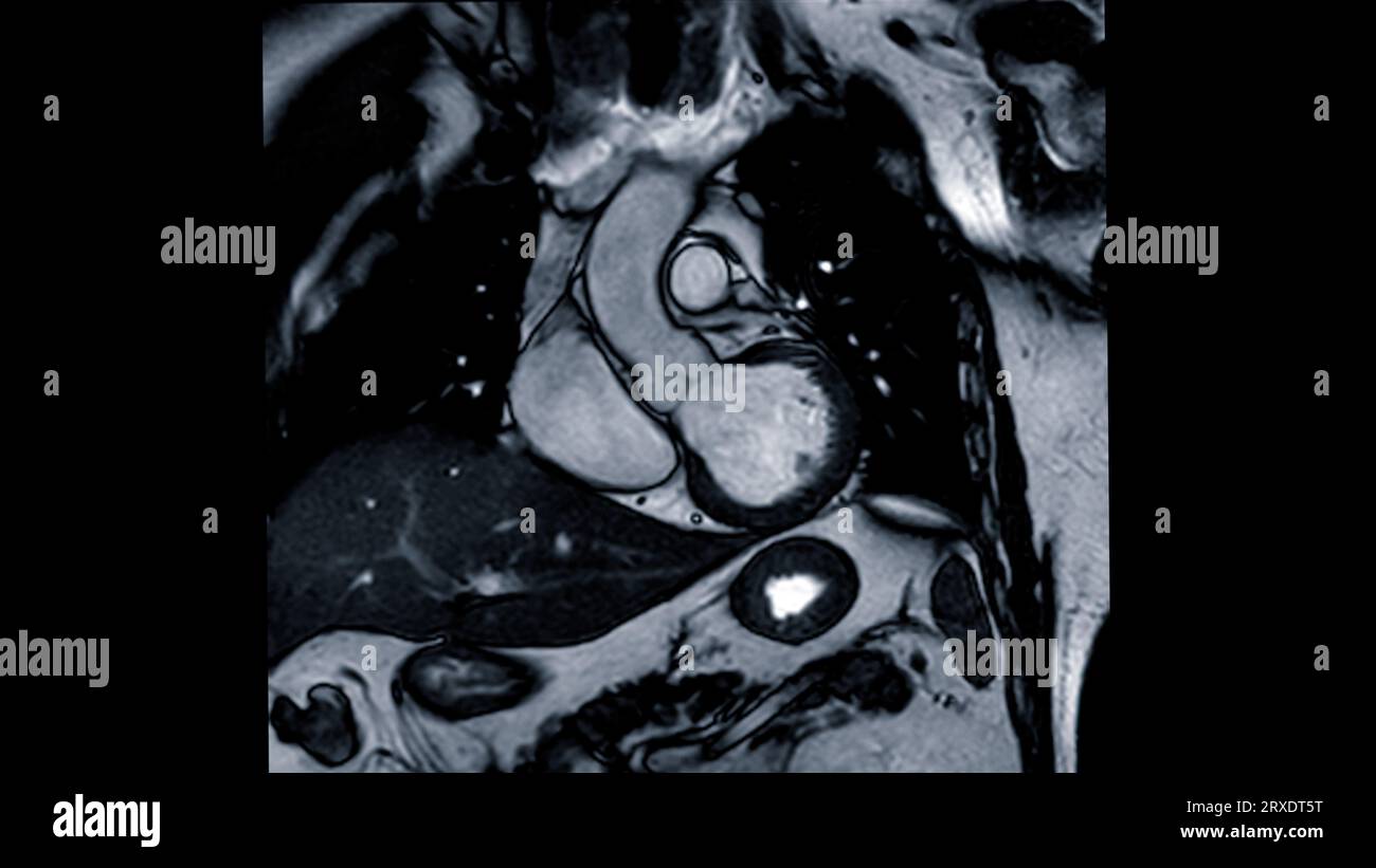 MRI heart or Cardiac MRI ( magnetic resonance imaging ) of heart in ...
