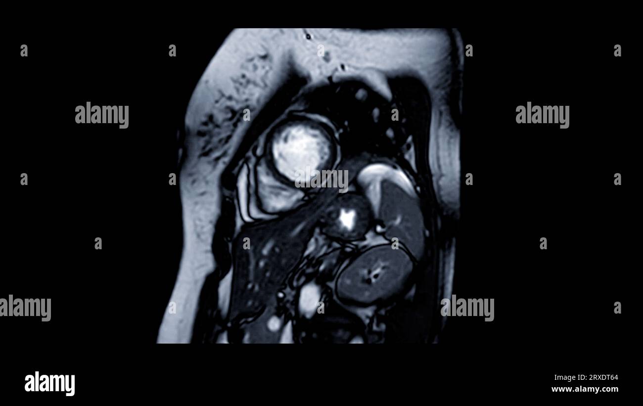 MRI heart or Cardiac MRI ( magnetic resonance imaging ) of heart in ...