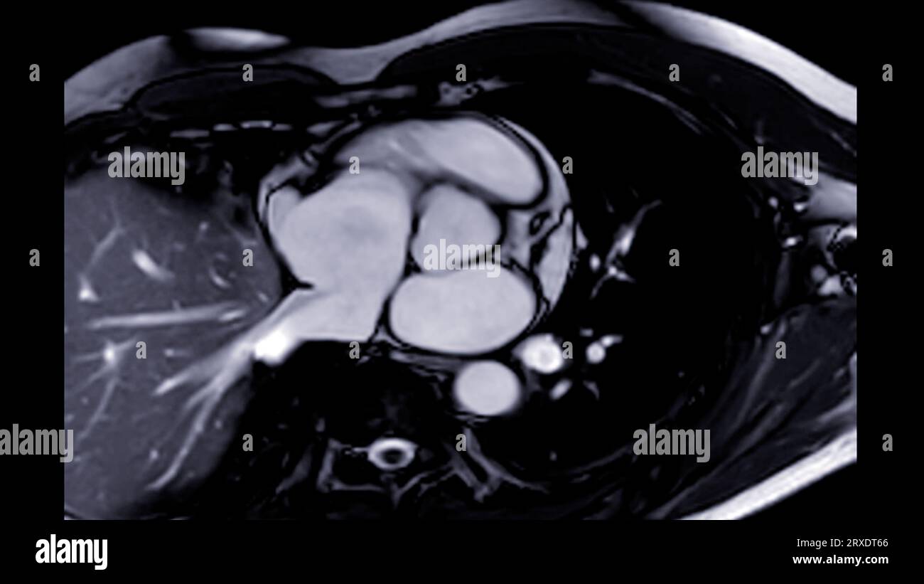 MRI heart or Cardiac MRI ( magnetic resonance imaging ) of heart for ...