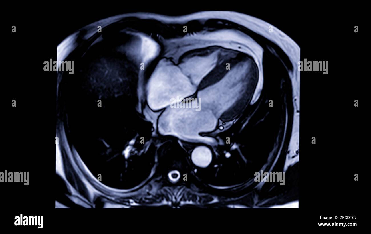 MRI heart or Cardiac MRI ( magnetic resonance imaging ) of heart for ...