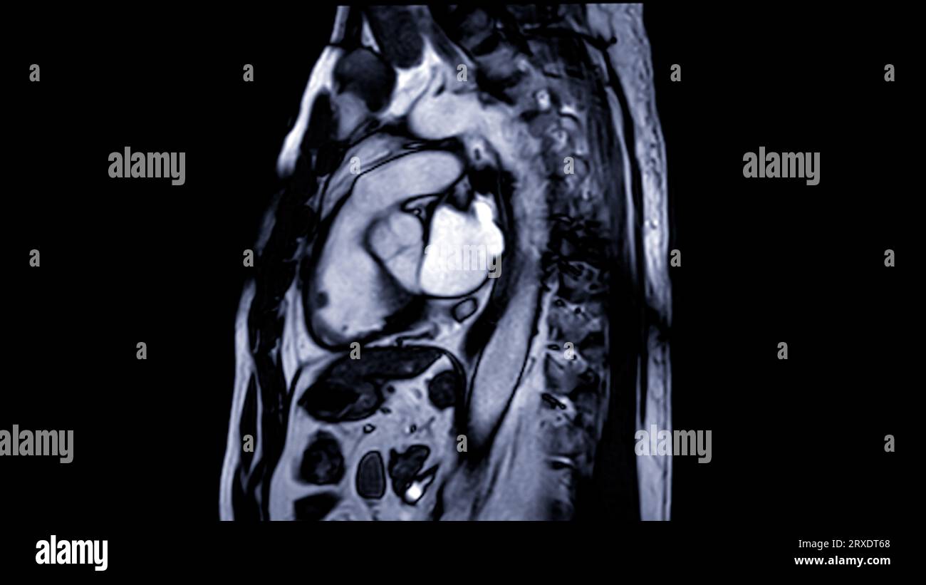 MRI heart or Cardiac MRI ( magnetic resonance imaging ) of heart for ...