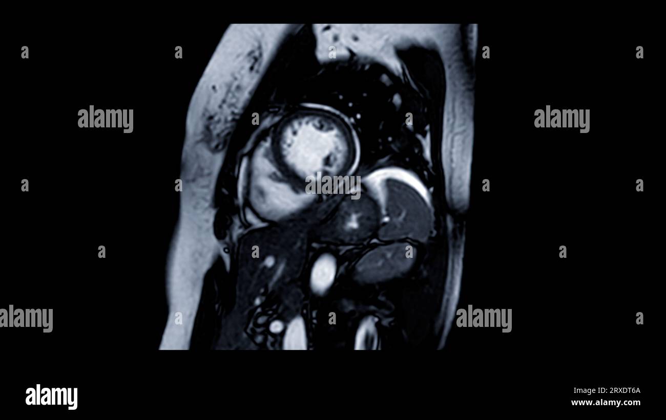 MRI heart or Cardiac MRI ( magnetic resonance imaging ) of heart for ...