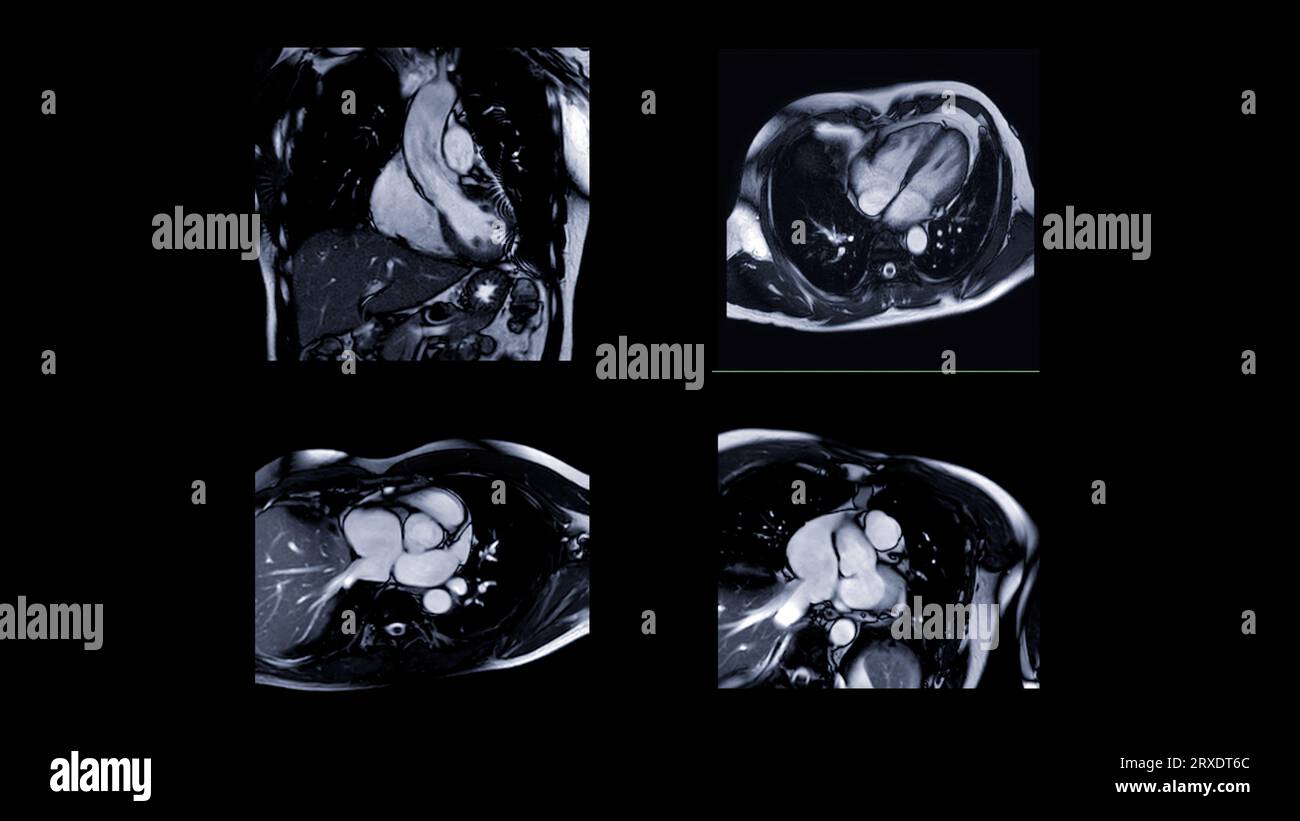 MRI heart or Cardiac MRI ( magnetic resonance imaging ) of heart for ...