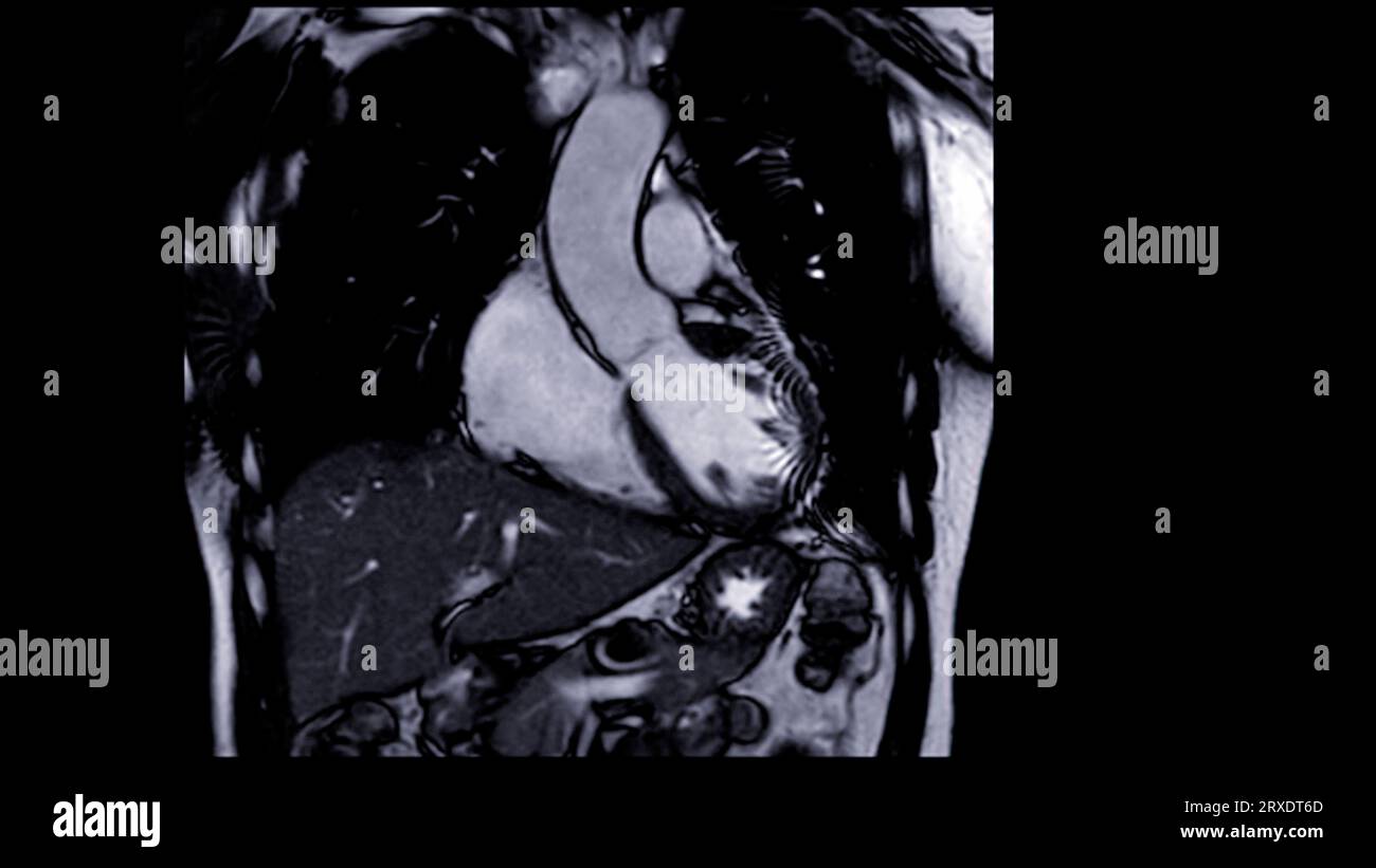 MRI heart or Cardiac MRI ( magnetic resonance imaging ) of heart in ...