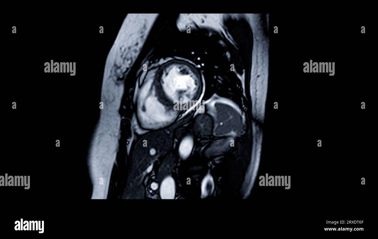 MRI heart or Cardiac MRI ( magnetic resonance imaging ) of heart in ...