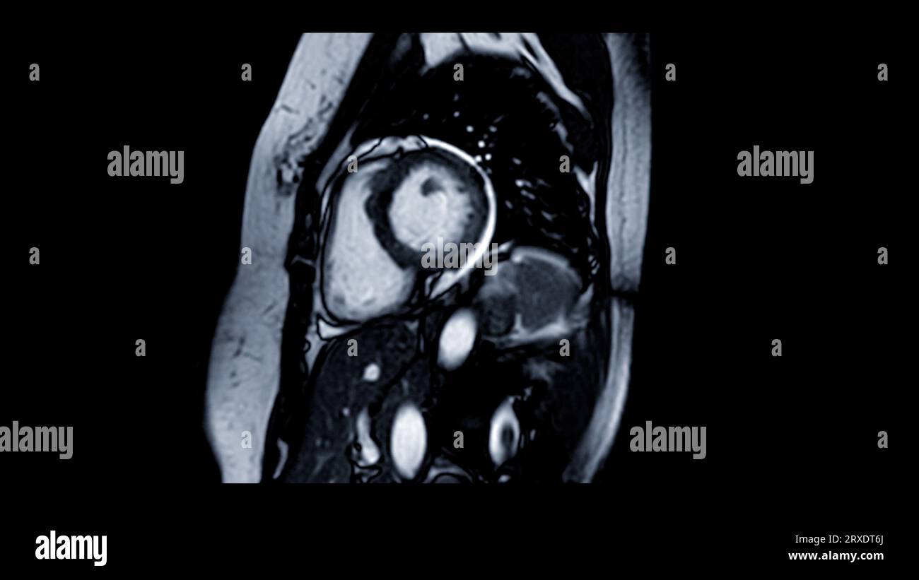 MRI heart or Cardiac MRI ( magnetic resonance imaging ) of heart in ...
