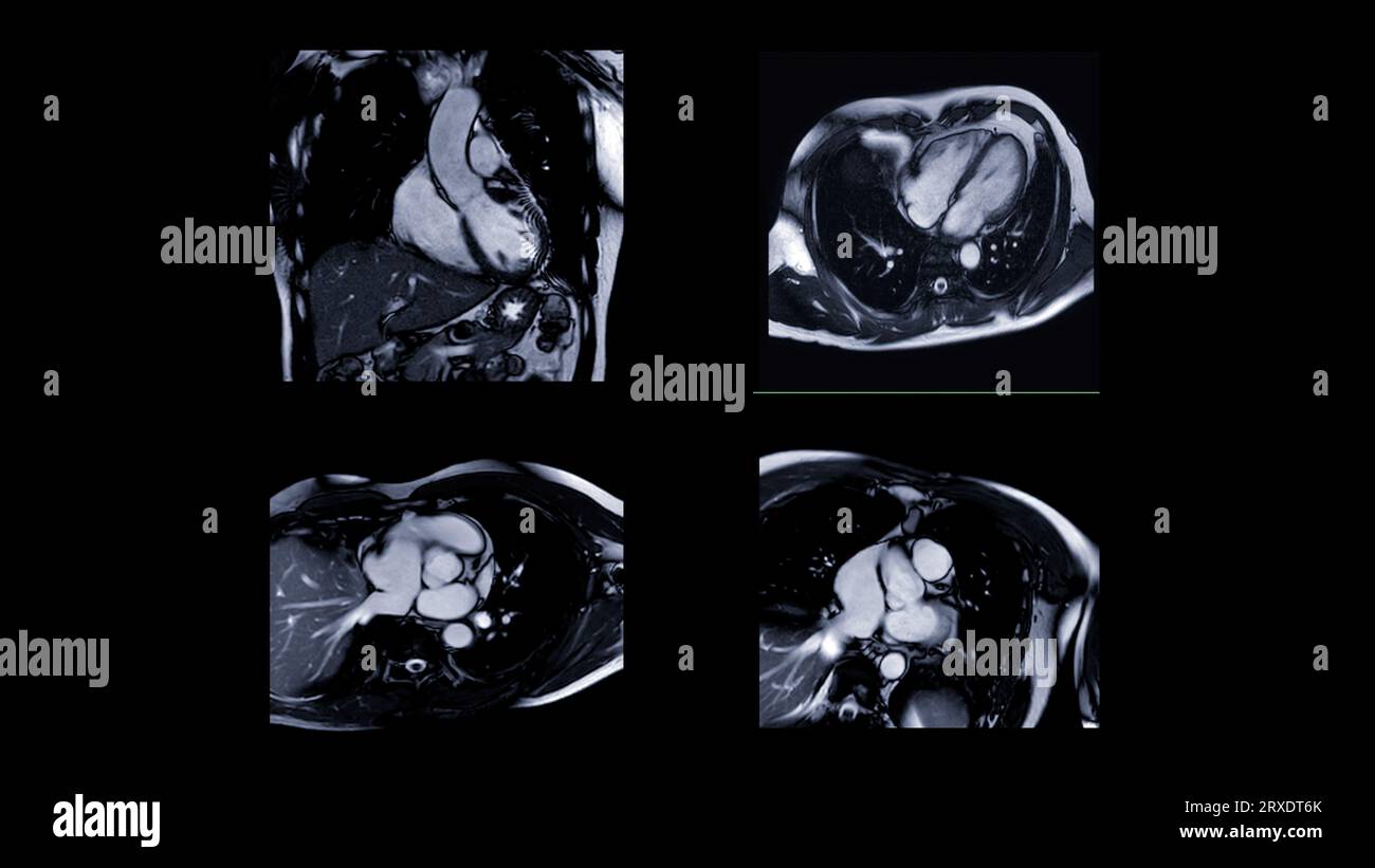 MRI heart or Cardiac MRI ( magnetic resonance imaging ) of heart for ...