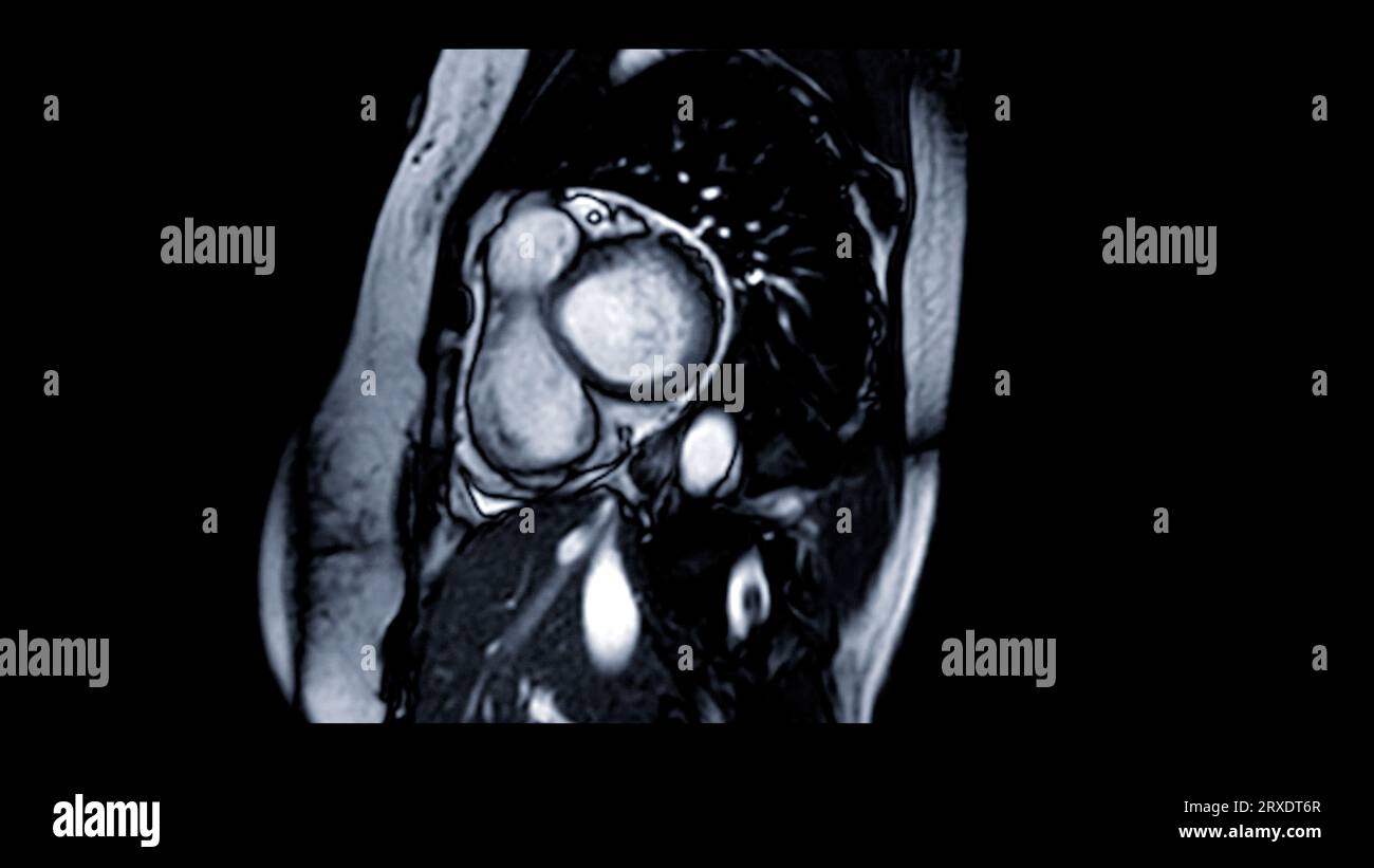 MRI heart or Cardiac MRI ( magnetic resonance imaging ) of heart in ...