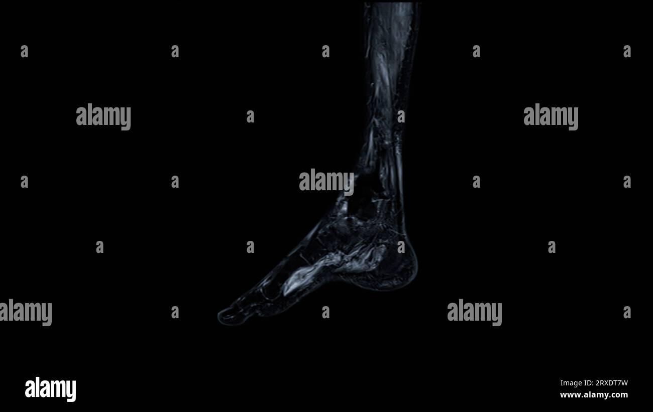 MRI FOOT scan Sagittal view T2 Fat suppression technique for diagnostic ...