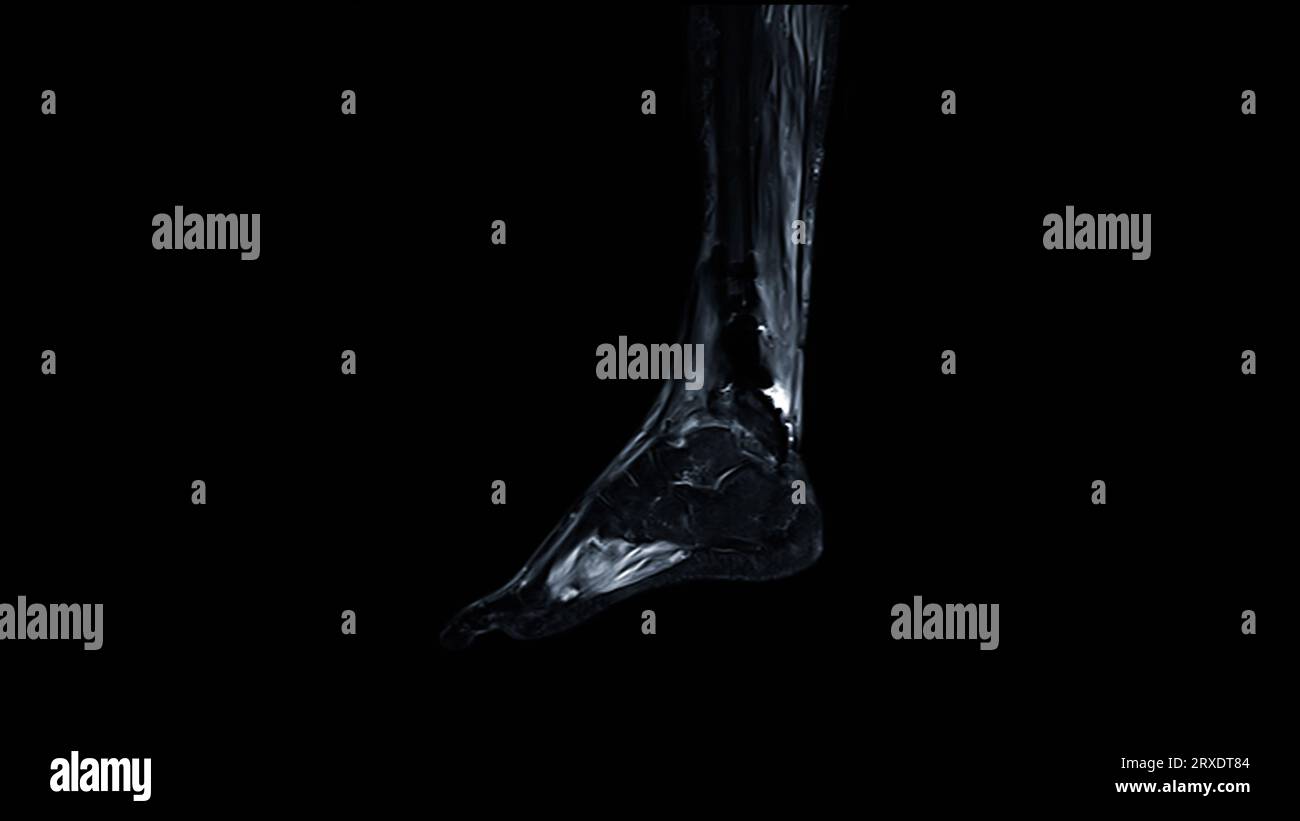 MRI FOOT scan Sagittal view T2 Fat suppression technique for diagnostic ...