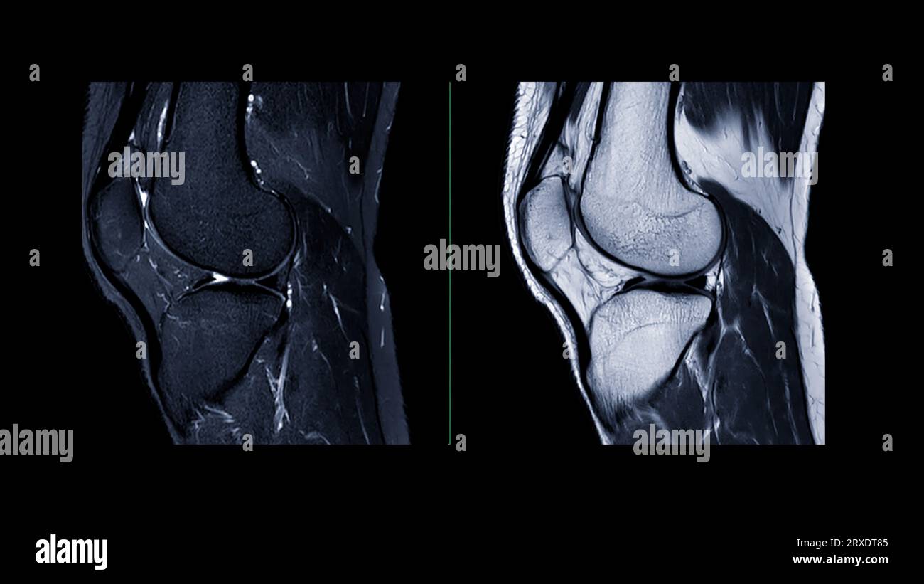 Magnetic resonance imaging of knee joint or MRI knee sagittal for ...