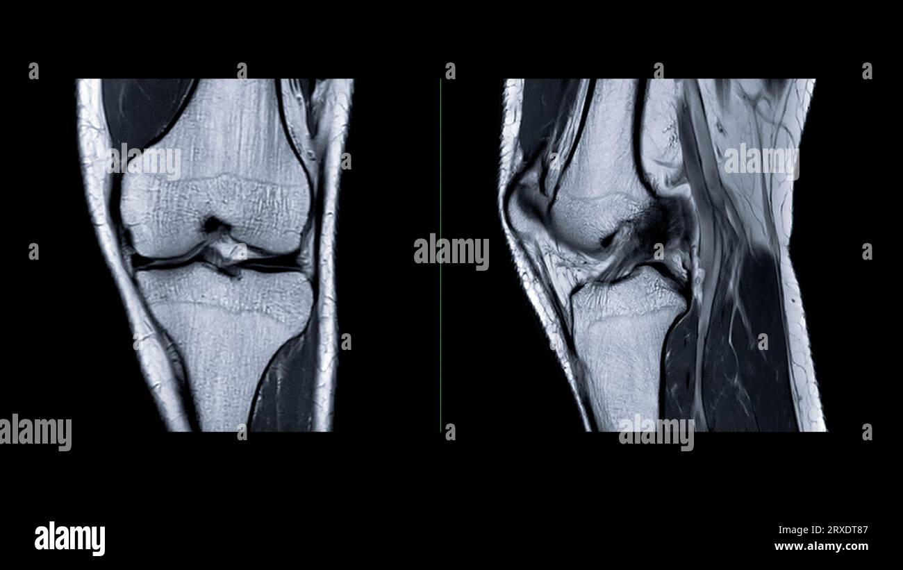 Magnetic resonance imaging of knee joint or MRI knee sagittal for ...