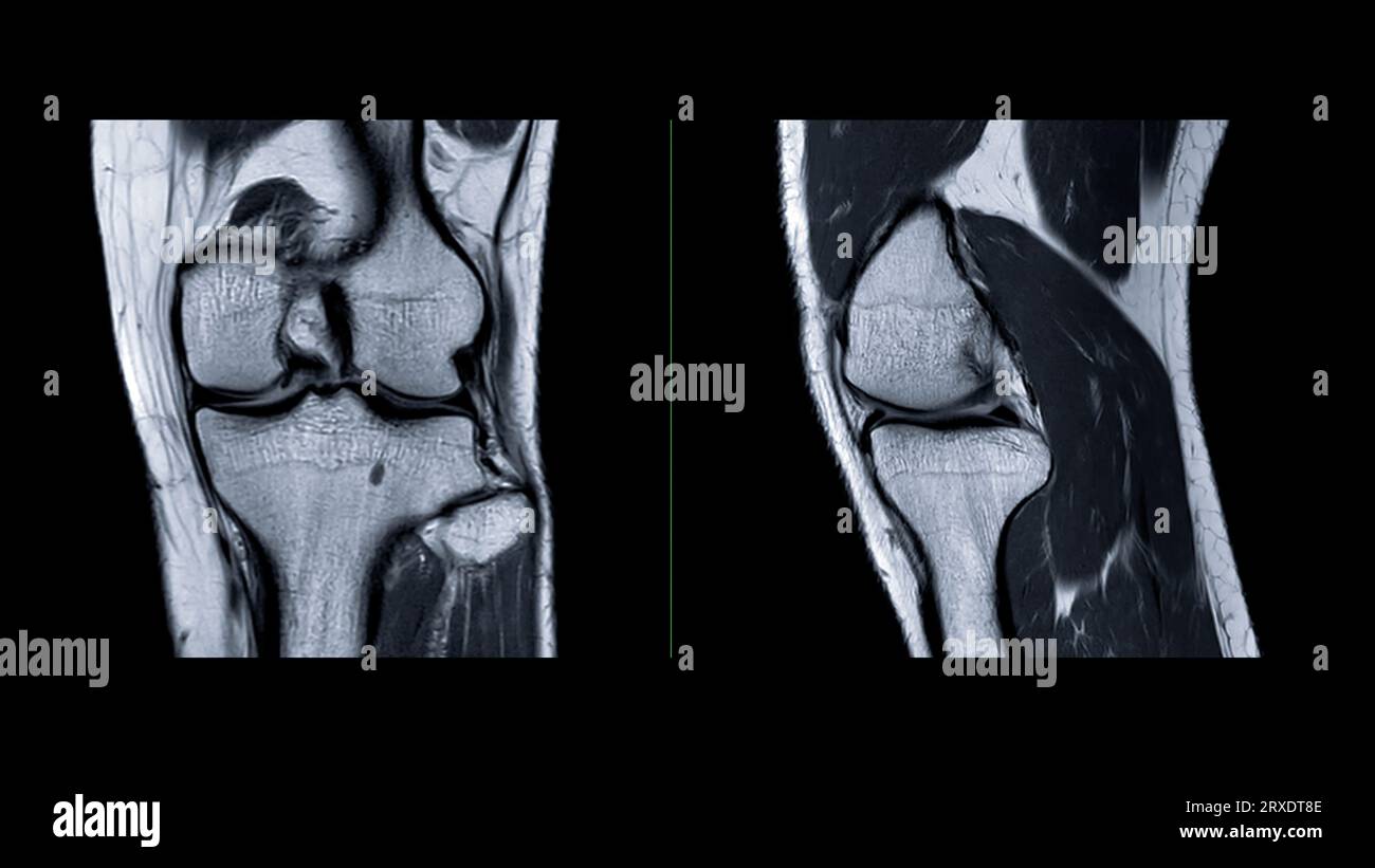 Magnetic resonance imaging of knee joint or MRI knee sagittal for ...