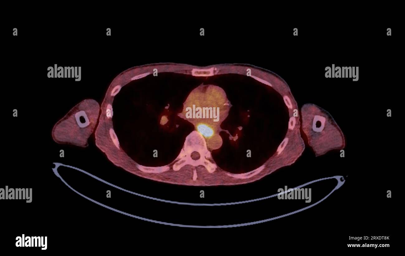 PET CT image of Whole human body Axial ,coronal and sagittal plane ...