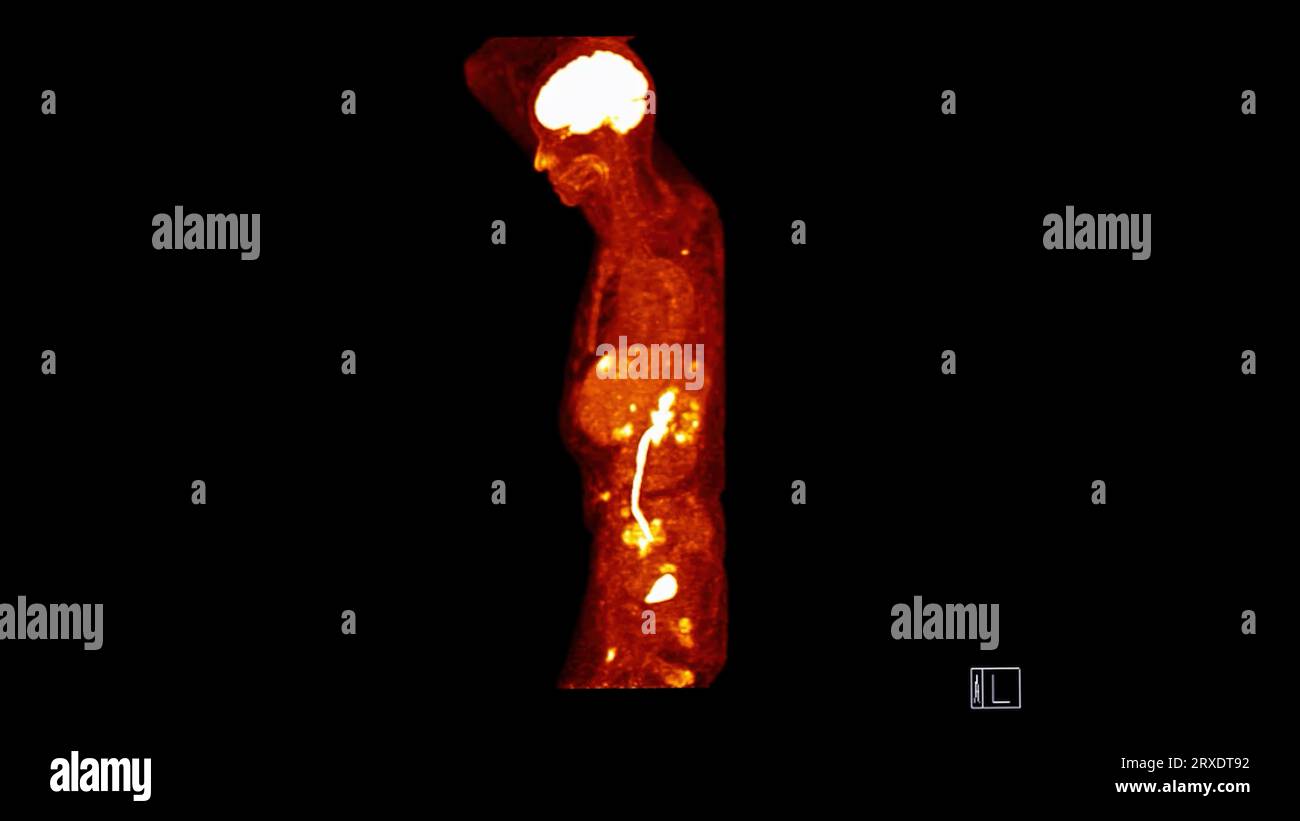 PET CT image of Whole human body sagittal plane. Positron Emission ...