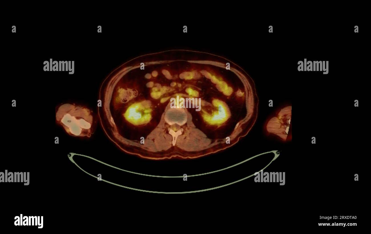 PET CT image of Whole human body Axial plane. Positron Emission ...