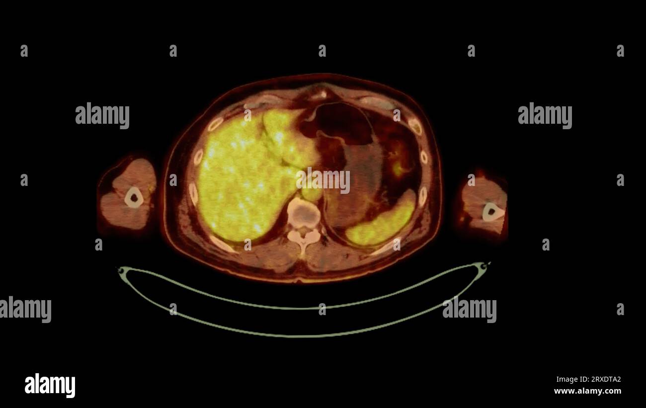PET CT image of Whole human body Axial plane. Positron Emission ...
