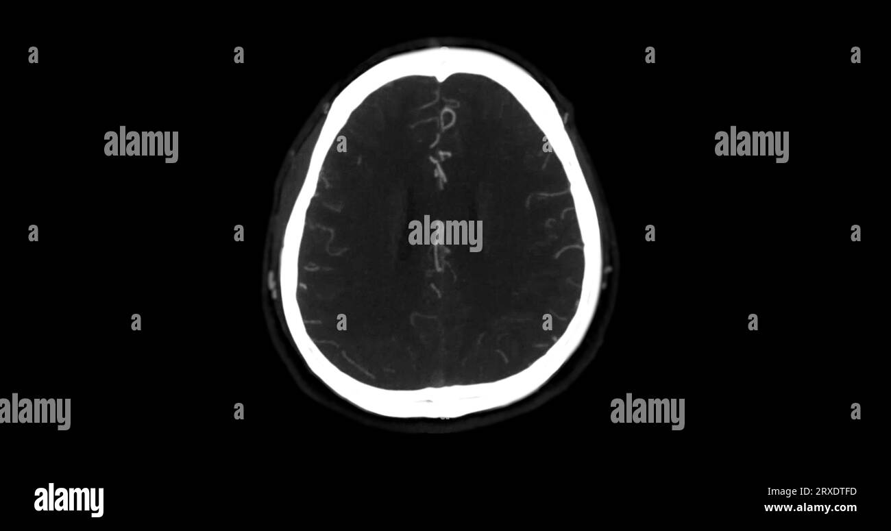 CTA BRAIN or CT angiography of the brain axial mip view showing ...