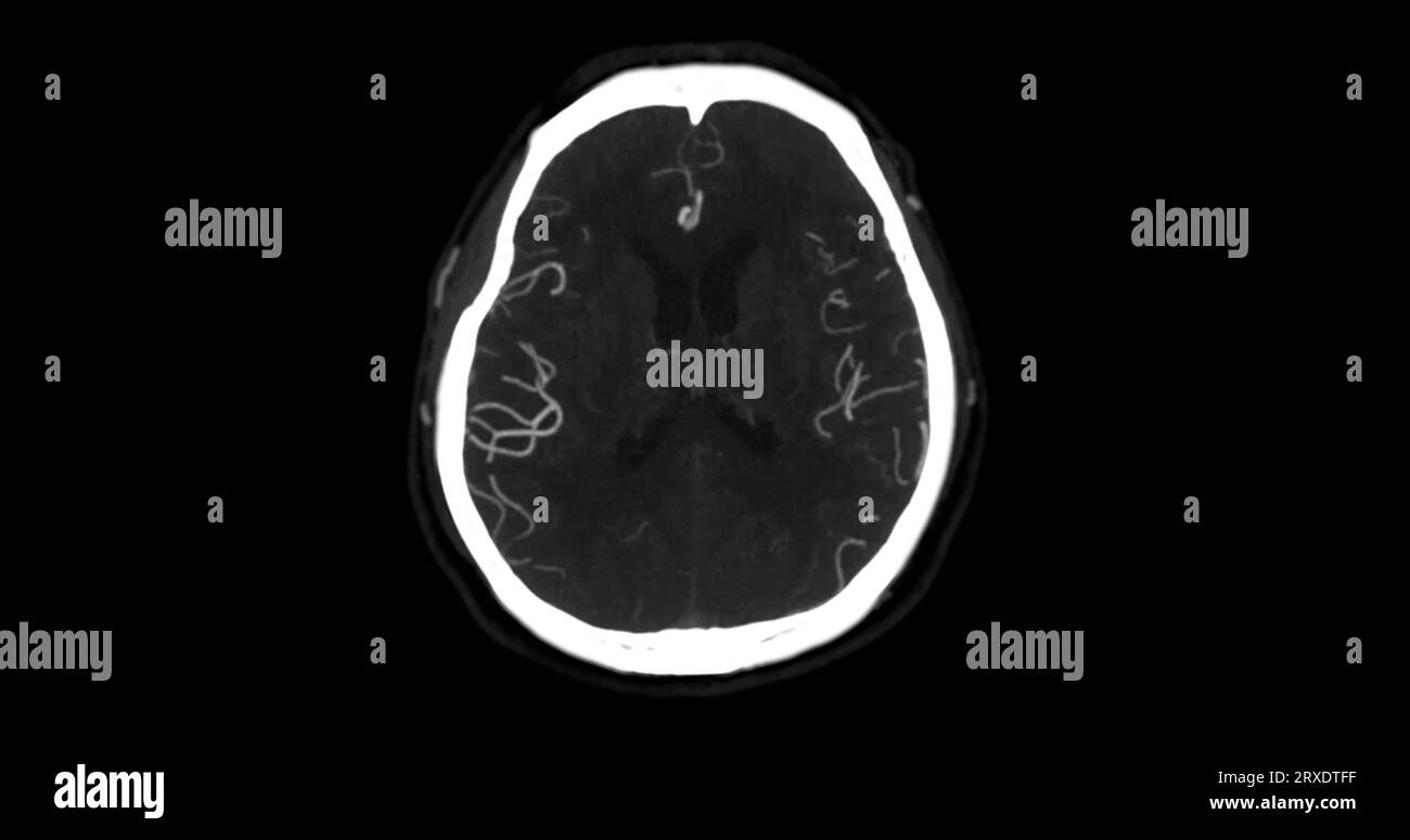 CTA BRAIN or CT angiography of the brain axial mip view showing cerebral artery Stock Photo - Alamy