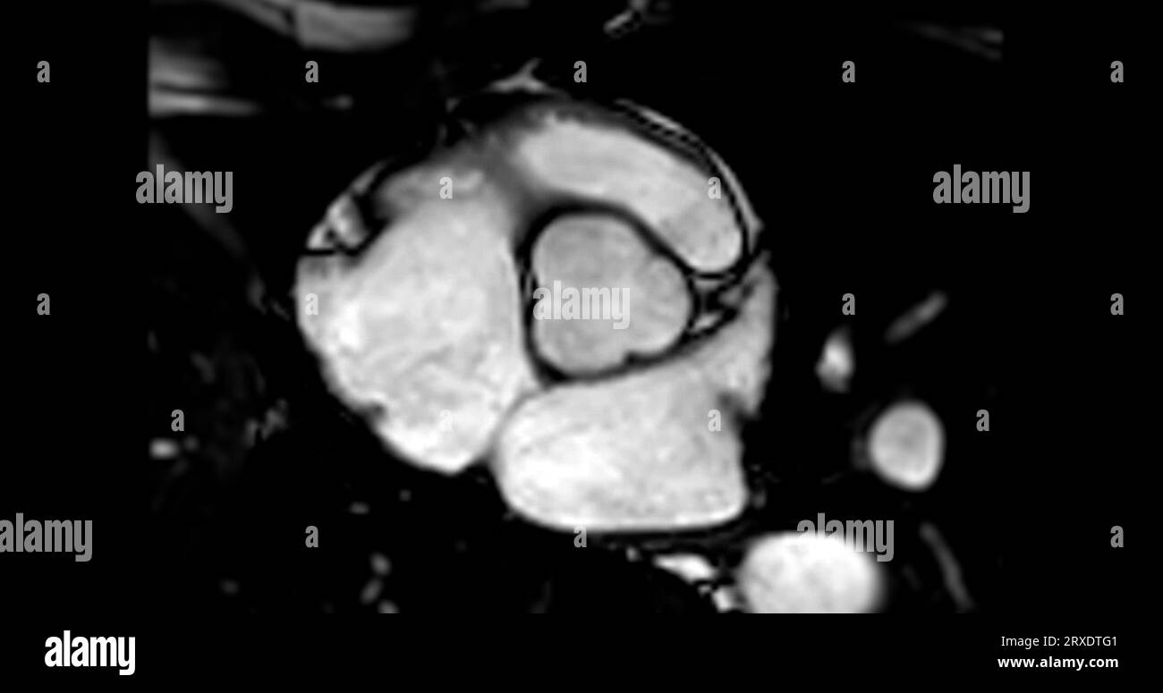 MRI heart or Cardiac MRI ( magnetic resonance imaging ) of heart ...