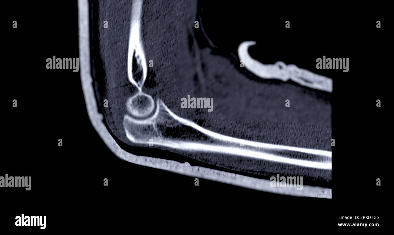 CT scan of elbow joint sagittal view Stock Photo - Alamy