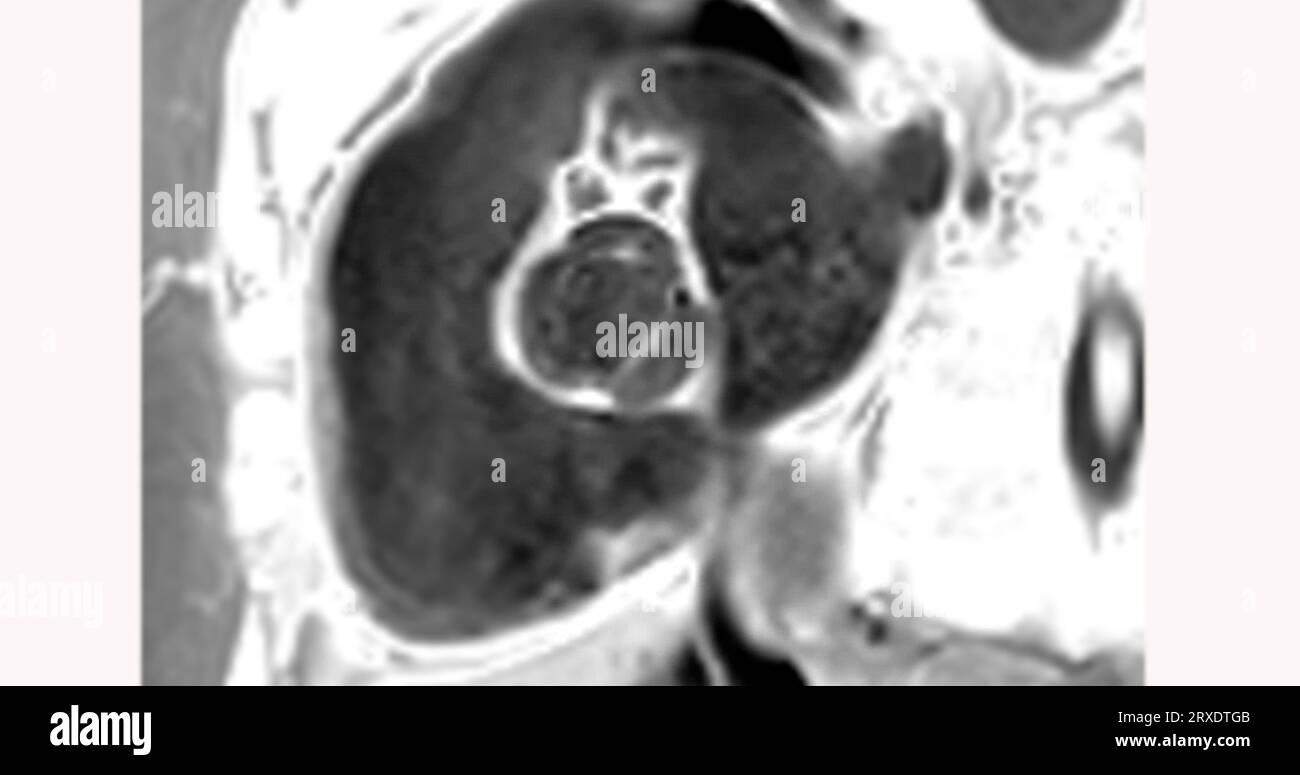 MRI heart or Cardiac MRI ( magnetic resonance imaging ) of heart ...