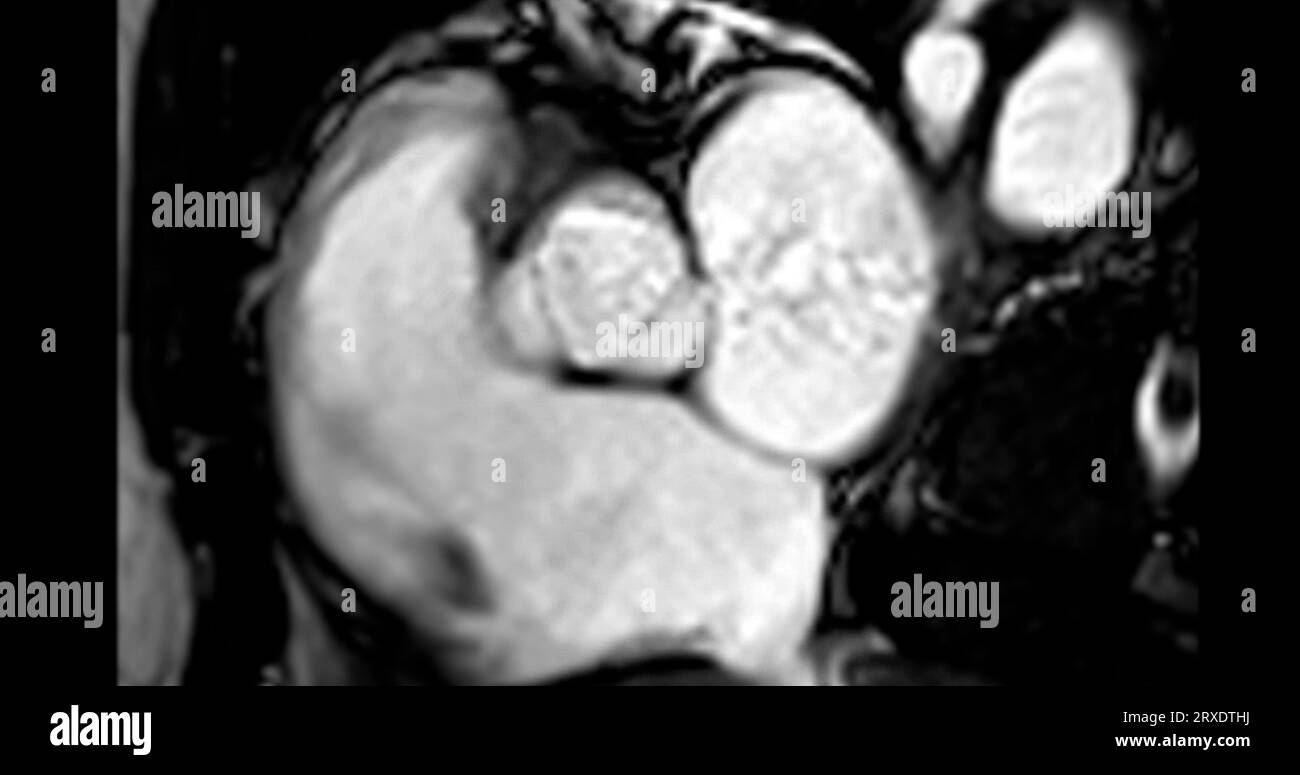 MRI heart or Cardiac MRI ( magnetic resonance imaging ) of heart ...
