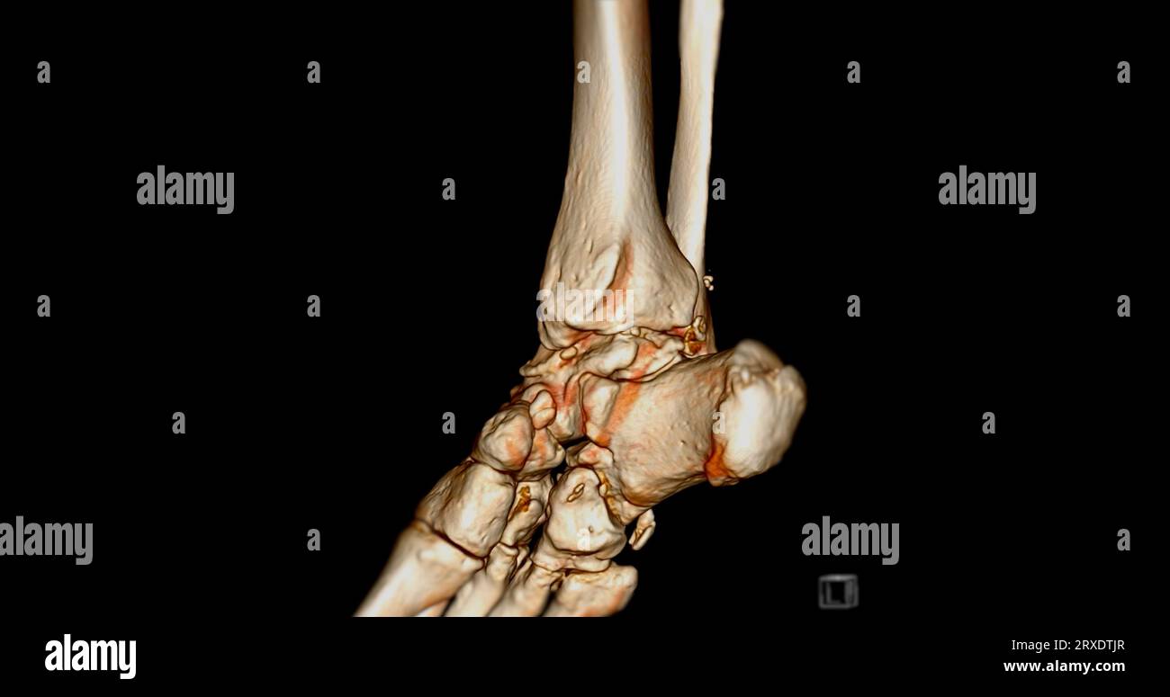 CT Scan ankle joint or Computed Tomography of Ankle joint 3D Rendering ...