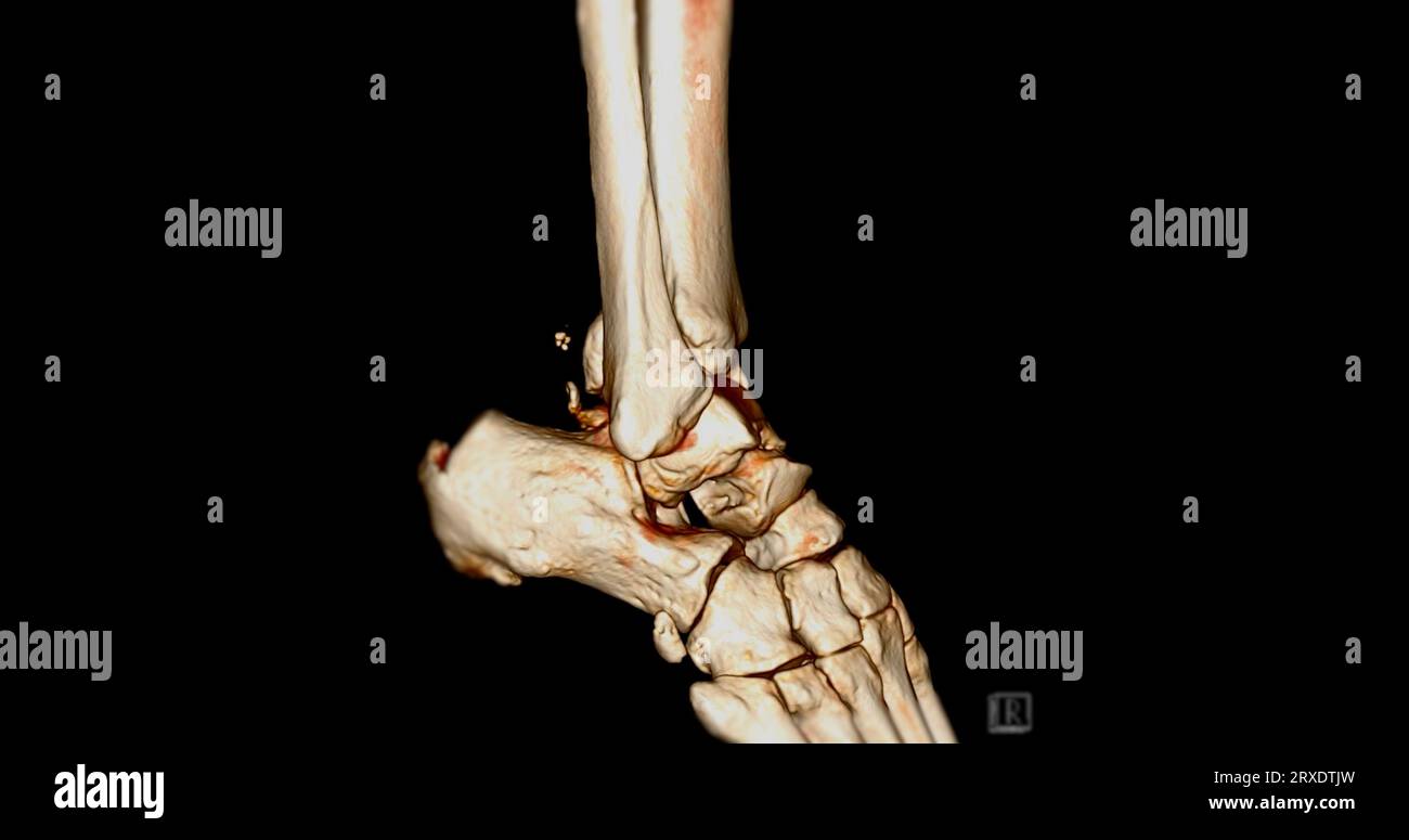 CT Scan ankle joint or Computed Tomography of Ankle joint 3D Rendering ...