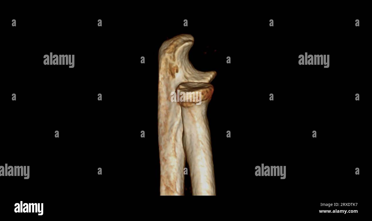 CT scan of elbow joint 3d rendering showing ulna and radius bone Stock ...