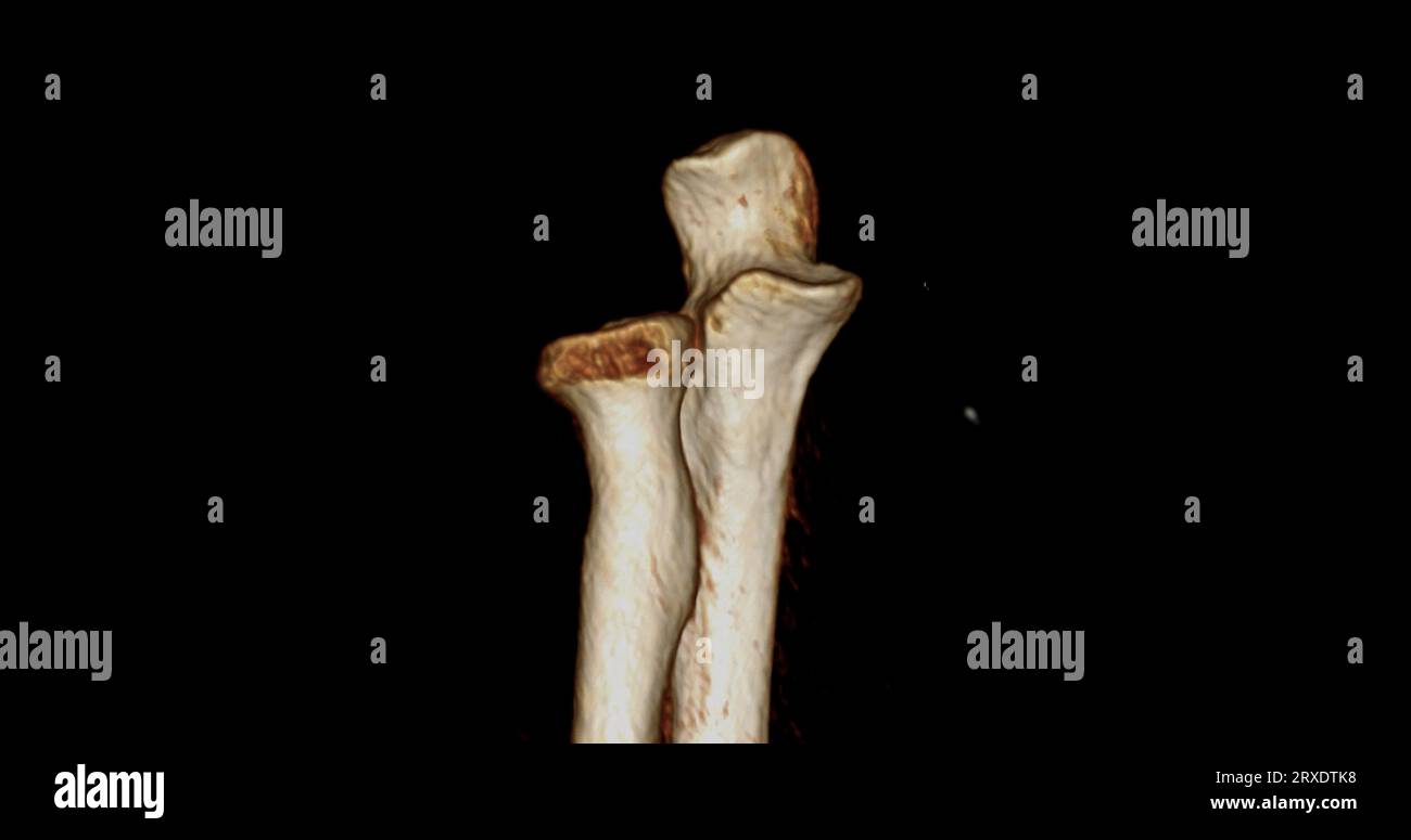 CT scan of elbow joint 3d rendering showing ulna and radius bone Stock ...