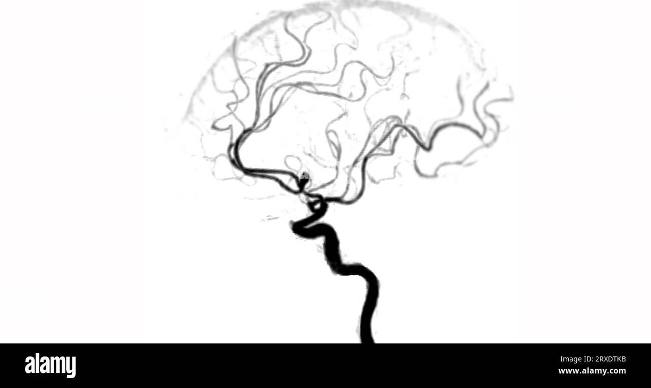 Cta Brain Or Ct Angiography Of The Brain Angiogram View Showing