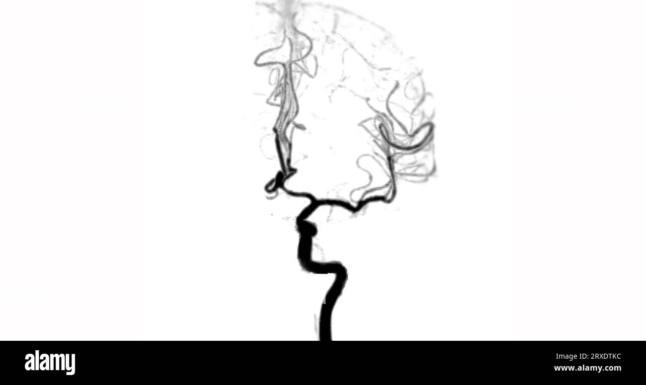 CTA BRAIN or CT angiography of the brain angiogram view showing ...