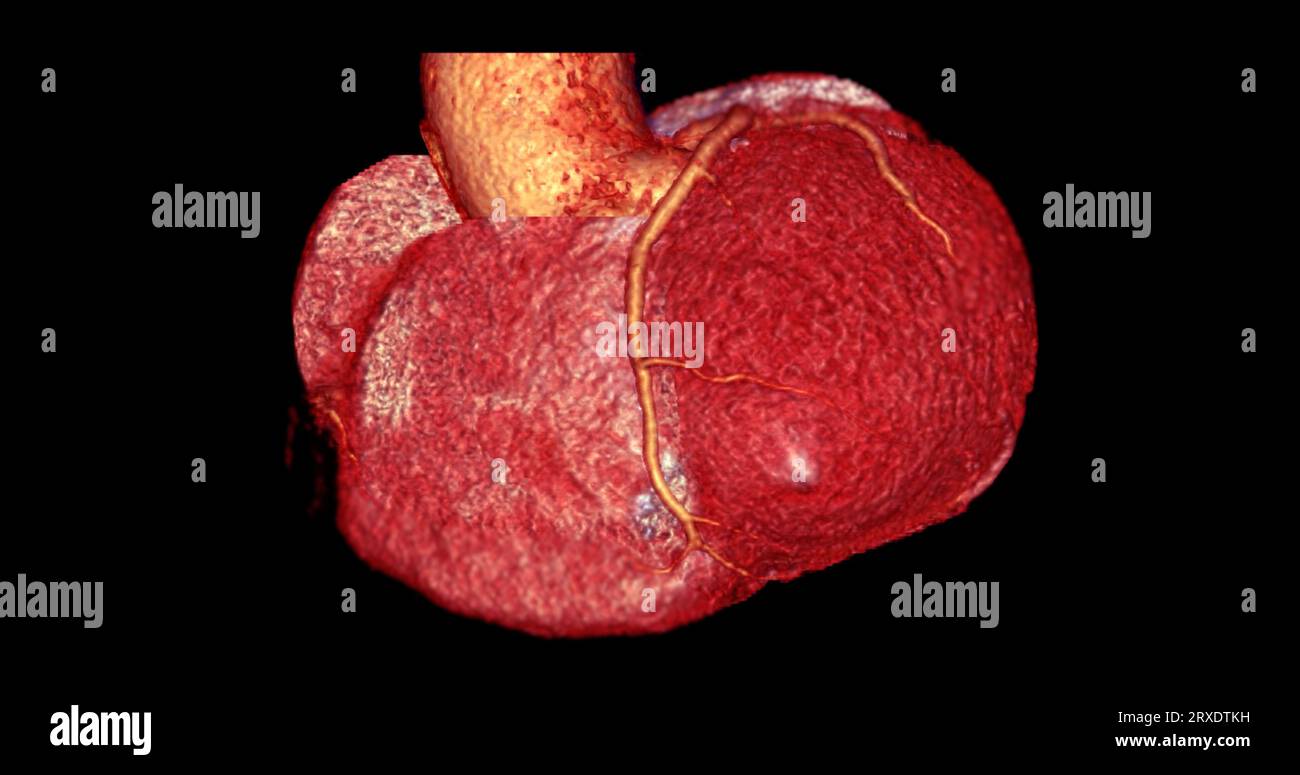 CT Cardiac 3D rendering or CTA coronary artery for prevention coronary ...